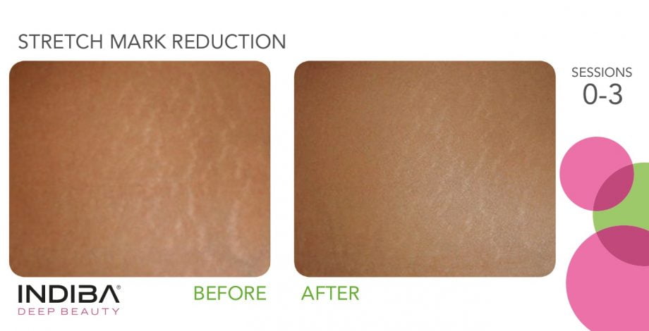 stretch marks | Tini's Spa